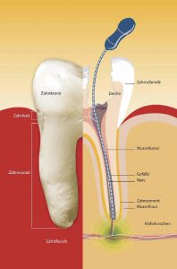 Endodontie, Wurzelkanalbehandlung, Wurzelbehandlung