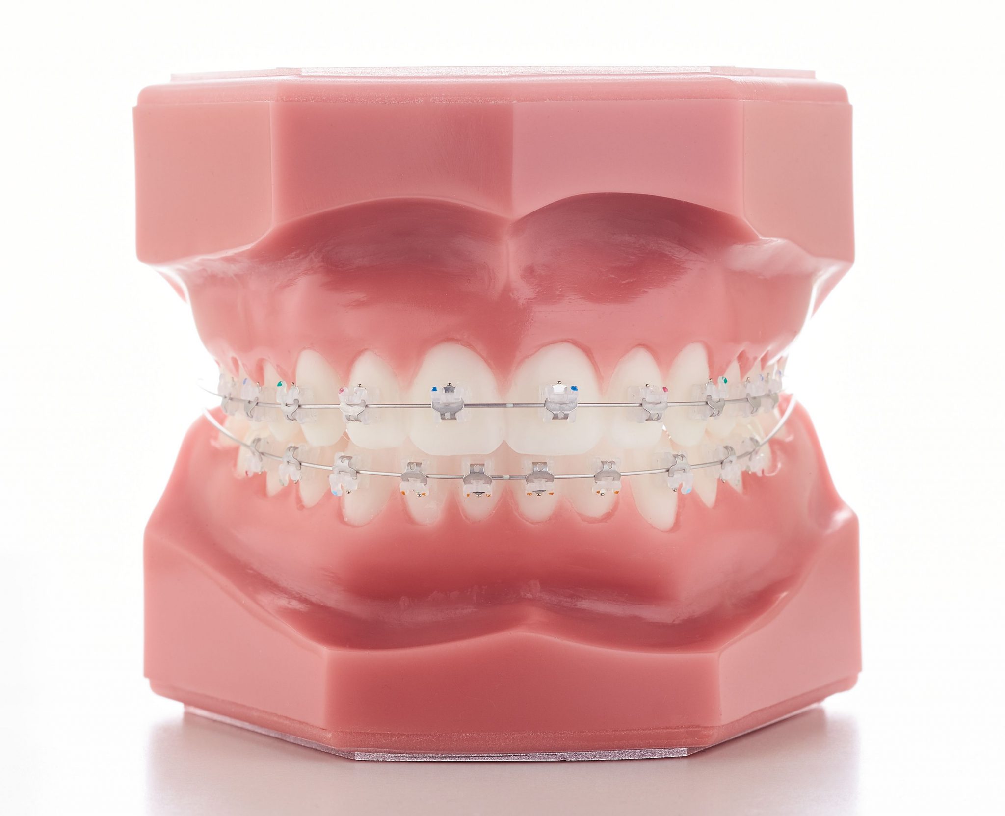 Kieferorthopädie, Zahnspangen, selbstligierende Brackets | Schienensysteme
